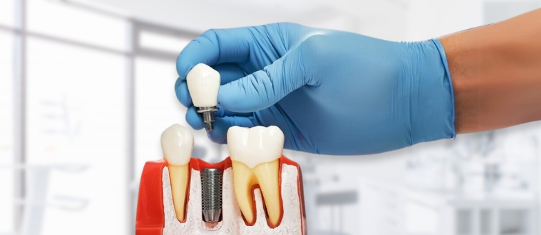 Reasons Dental Implants is Superior to Traditional Tooth Replacement